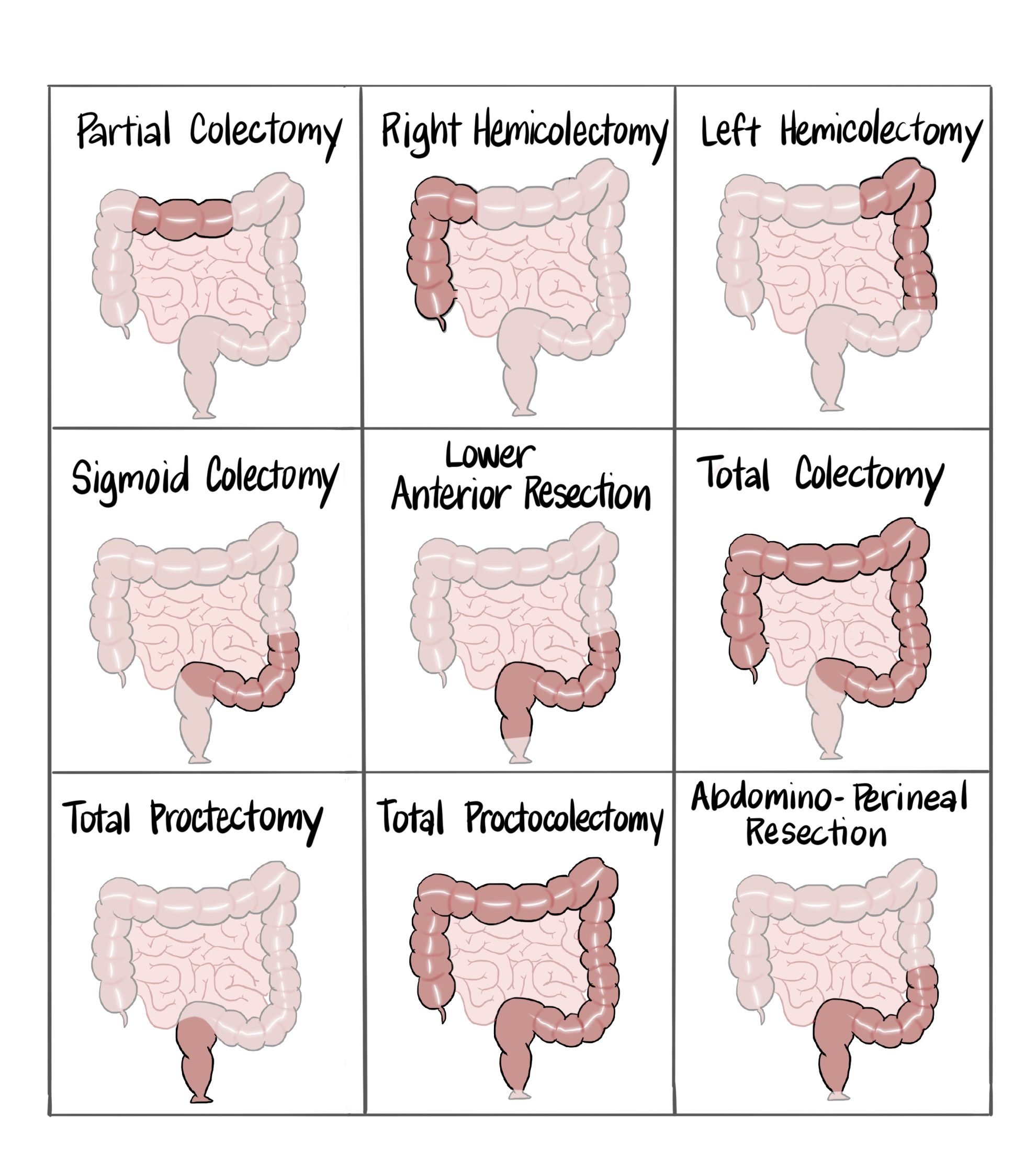 What kinds of surgery are there? - Colontown University
